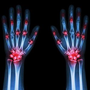 Arthrose der Hand (Rheuma / Polyarthritis) - Prof. Dr. Steinsträßer